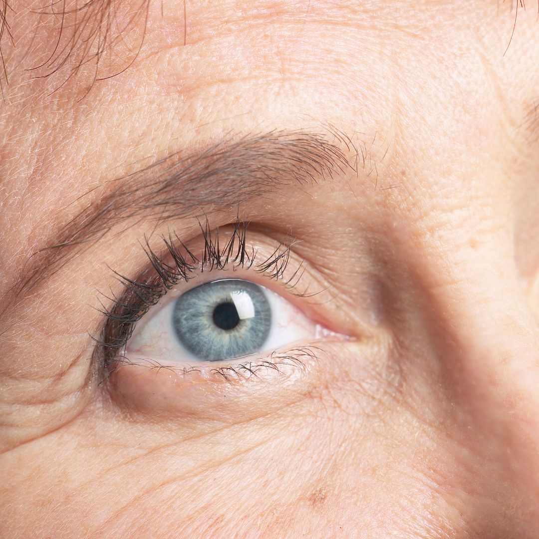 Hooded eyes - NewLife Aesthetics